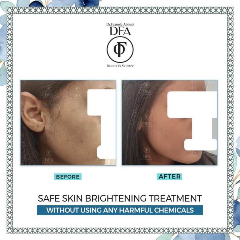Before and After | Dr. Fazeela