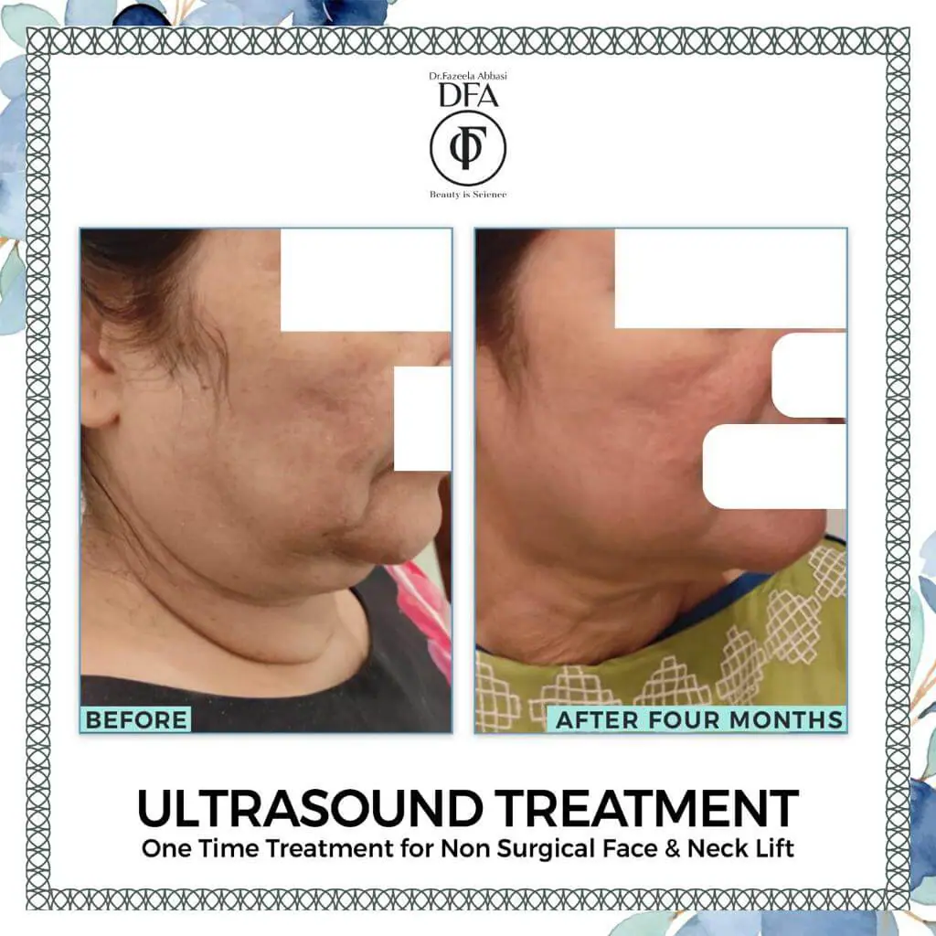 Before and After - Dr. Fazeela