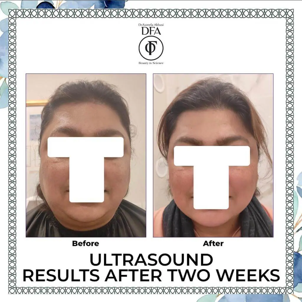 Before and After - Dr. Fazeela