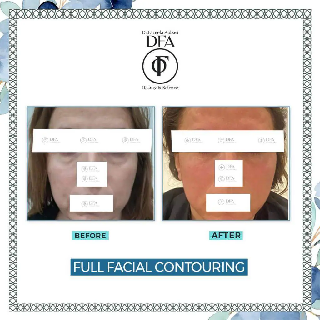 Before and After - Dr. Fazeela