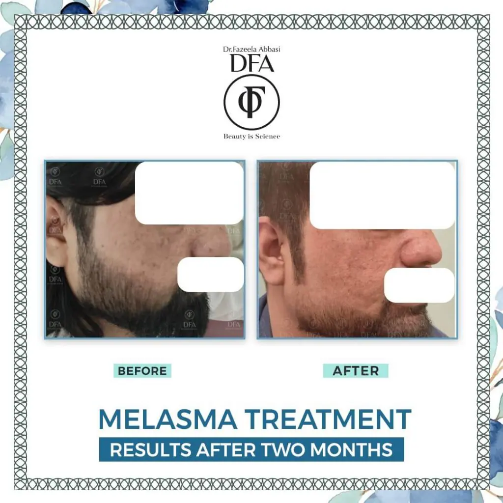 Before and After - Dr. Fazeela