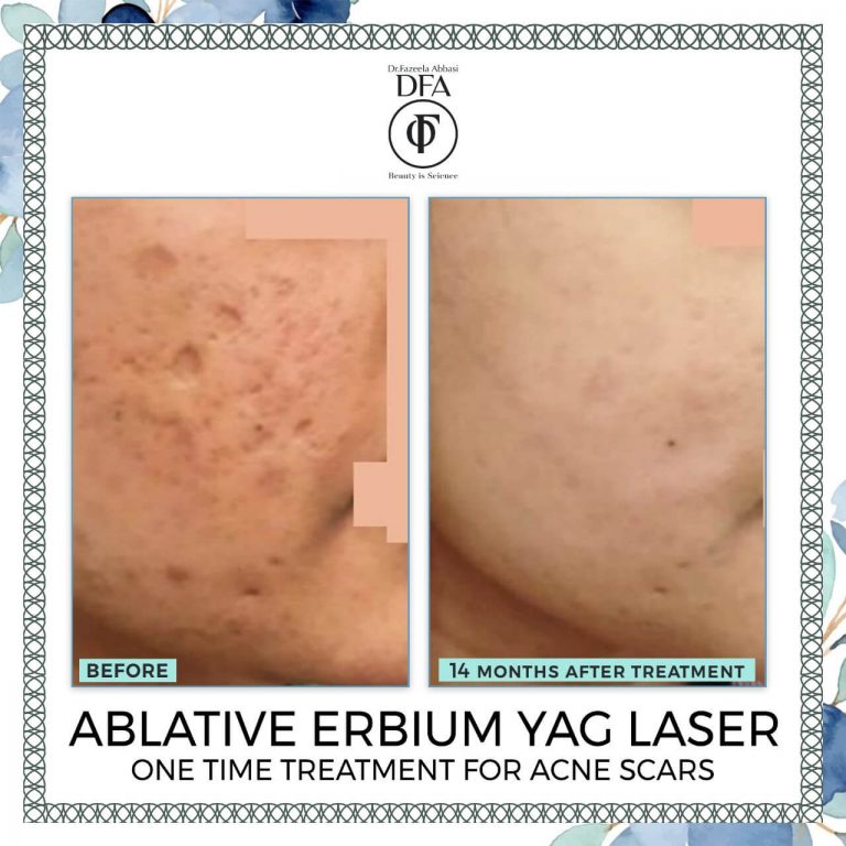 Get the Best Ablative Erbium YAG Laser Treatment in Islamabad