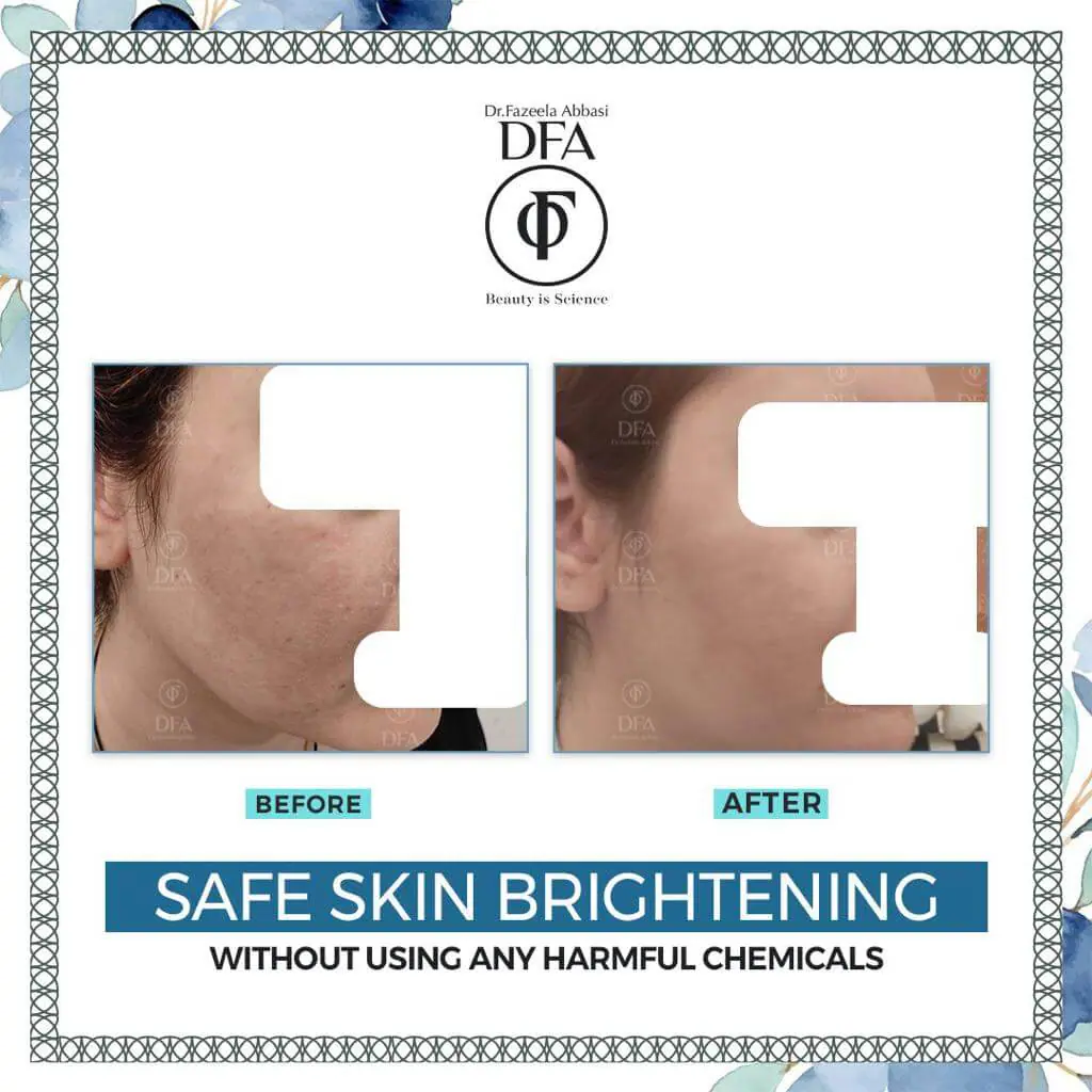 Before and After - Dr. Fazeela
