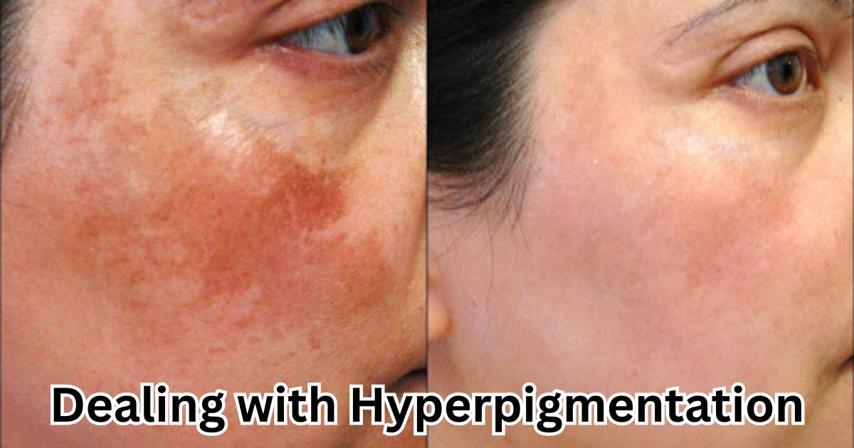 Dealing with Hyperpigmentation in Islamabad - Dr. Fazeela