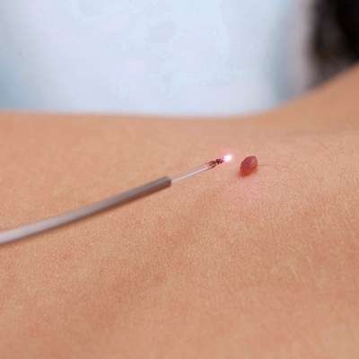 How Does Laser Wart Removal Work?